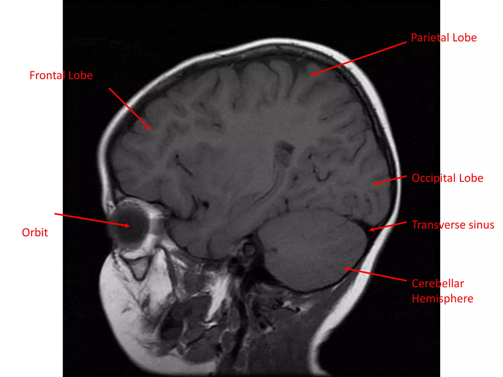 Normal mri brain | PPTX
