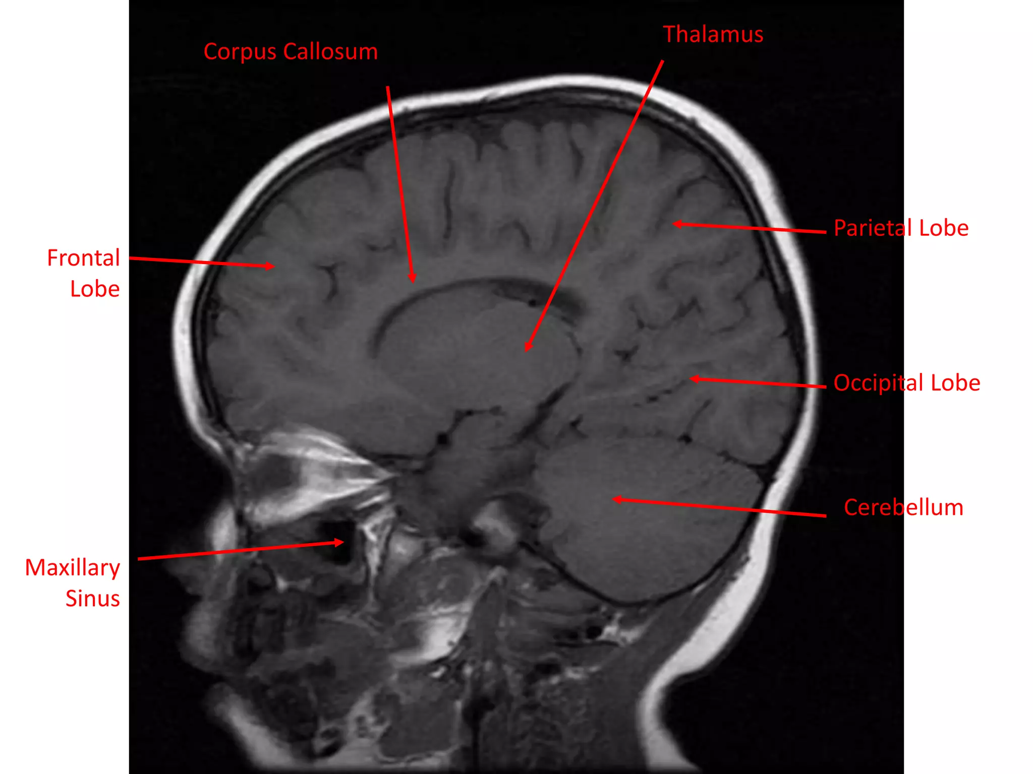 Normal mri brain | PPTX