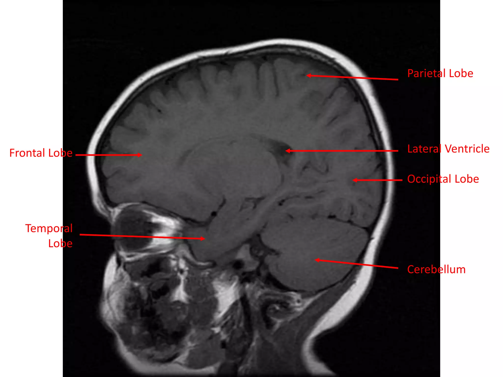 Normal mri brain | PPTX