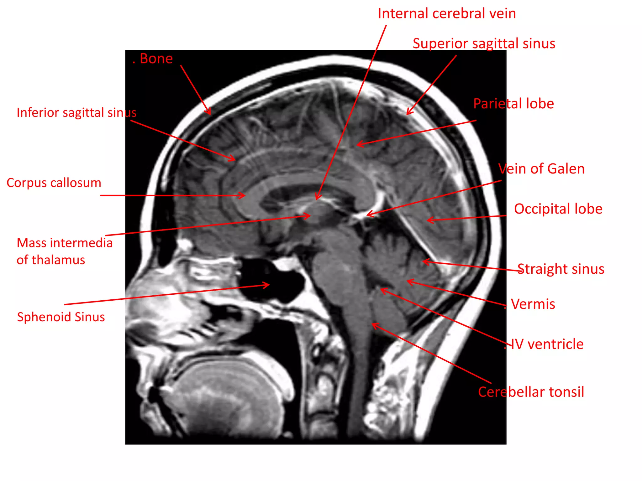 Normal mri brain | PPTX