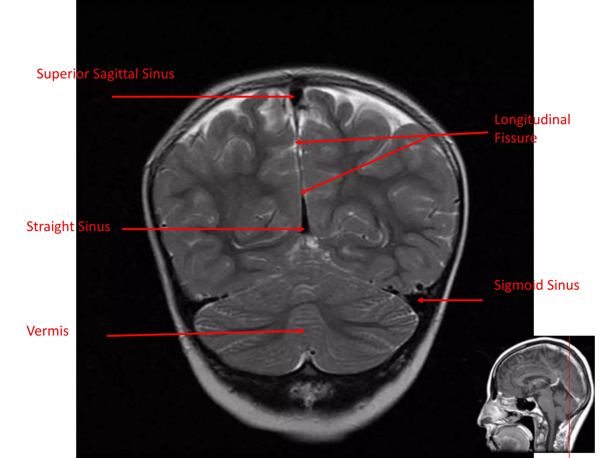 Normal mri brain | PPTX