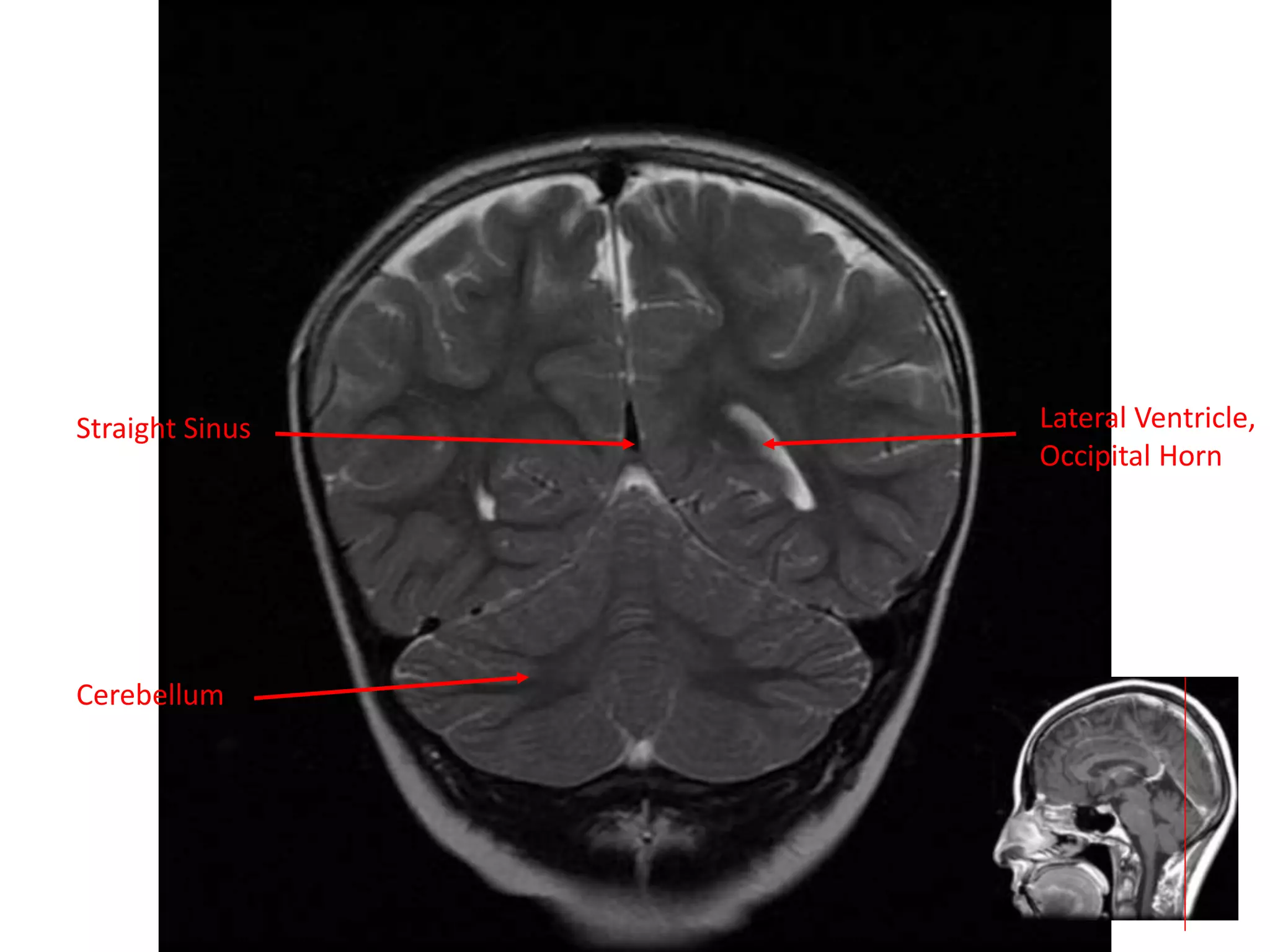 Normal mri brain | PPTX