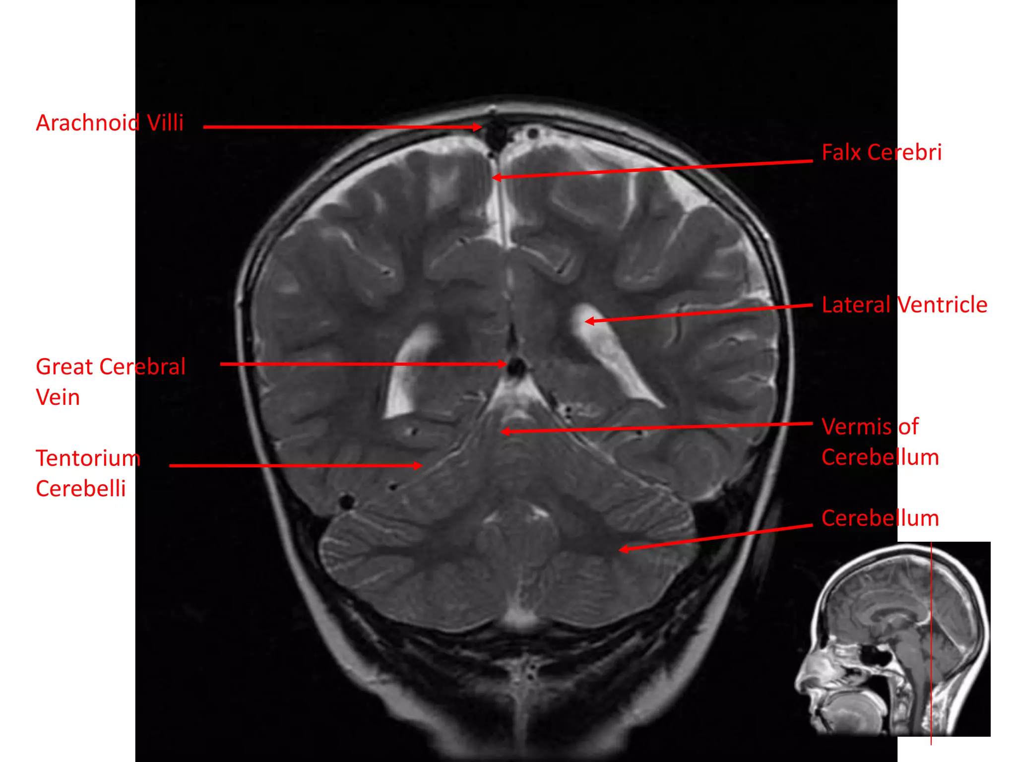 Normal mri brain | PPTX