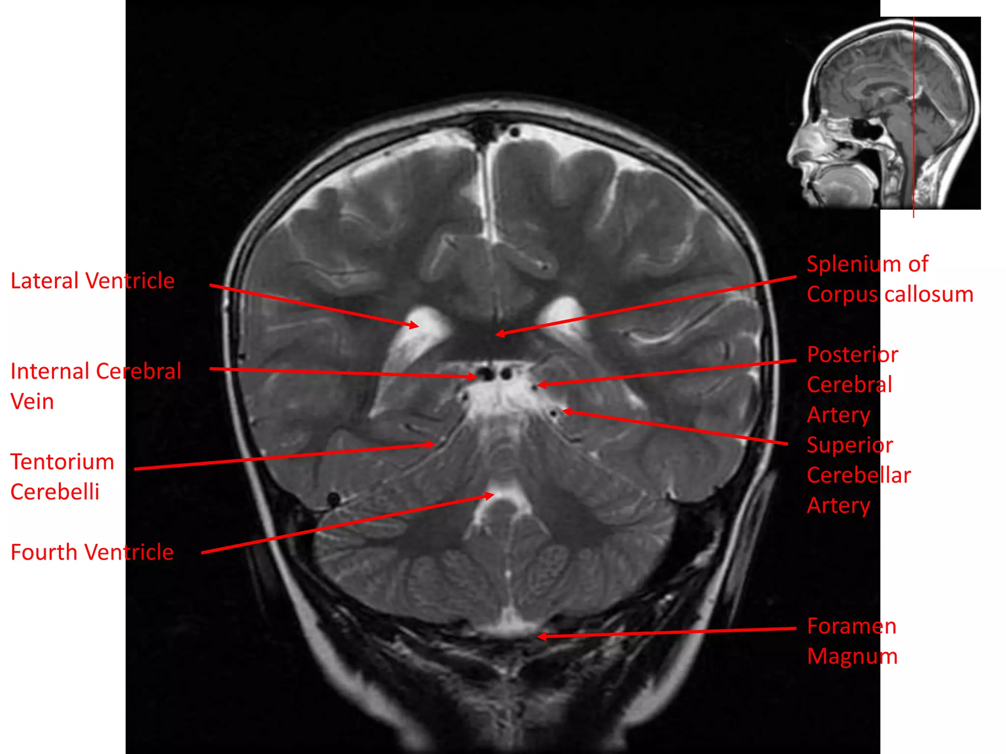 Normal mri brain | PPTX