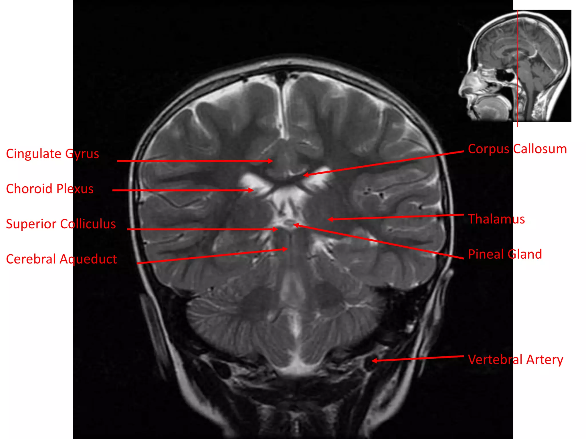 Normal mri brain | PPTX