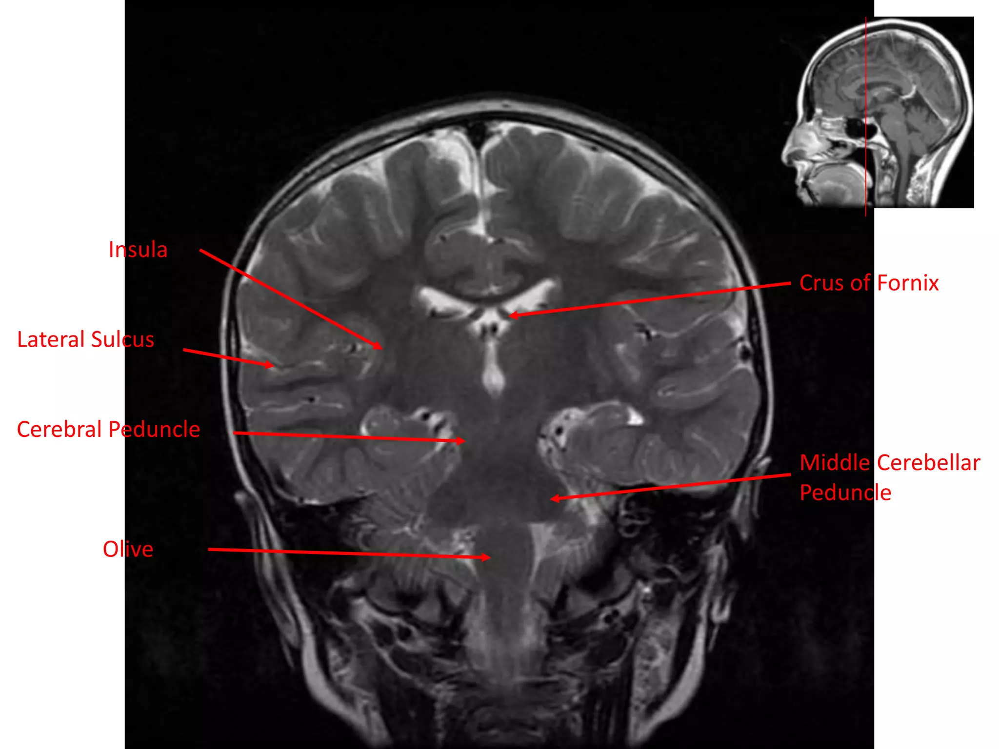 Normal mri brain | PPTX