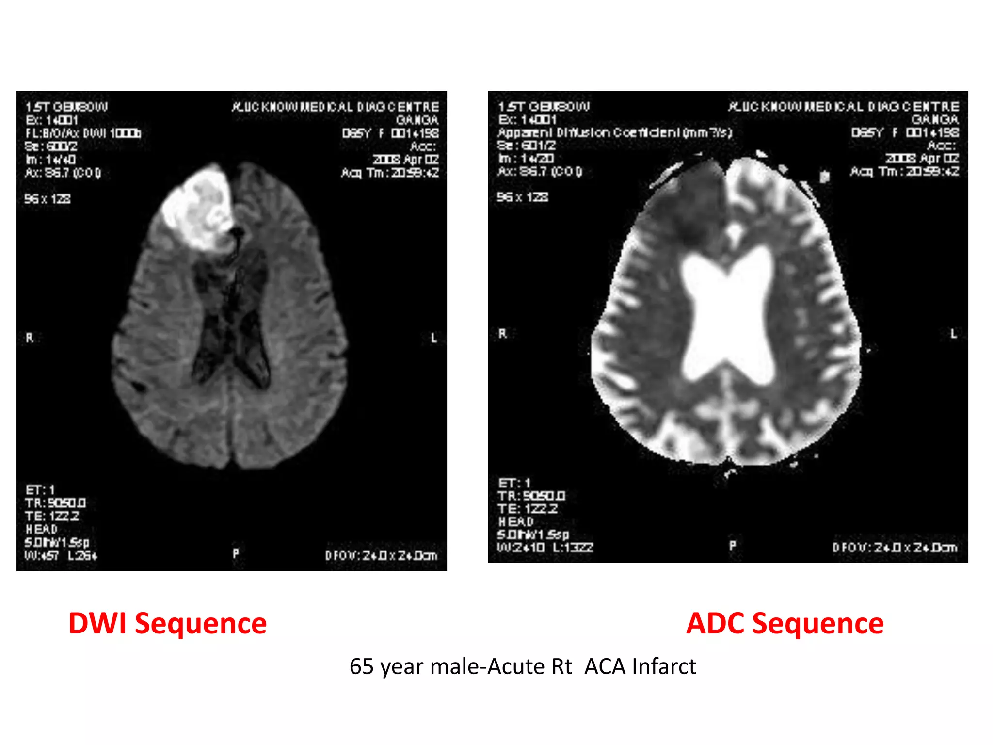 Normal mri brain | PPTX