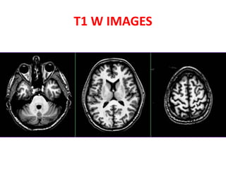 Normal mri brain | PPTX