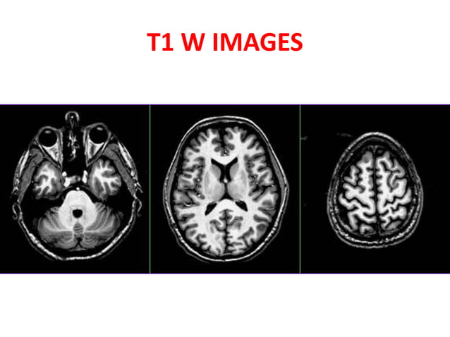 Normal mri brain | PPTX | Medical Tests | Medical Health