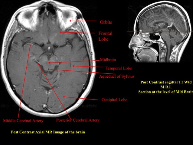 Normal mri brain | PPTX | Medical Tests | Medical Health