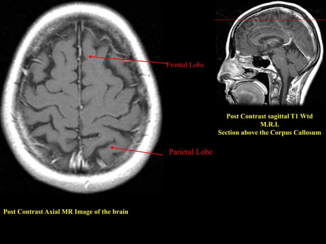 Normal mri brain | PPTX | Medical Tests | Medical Health