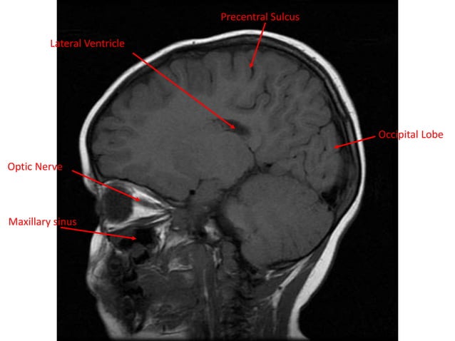 Normal mri brain | PPTX | Medical Tests | Medical Health