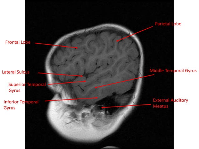 Normal mri brain | PPTX | Medical Tests | Medical Health