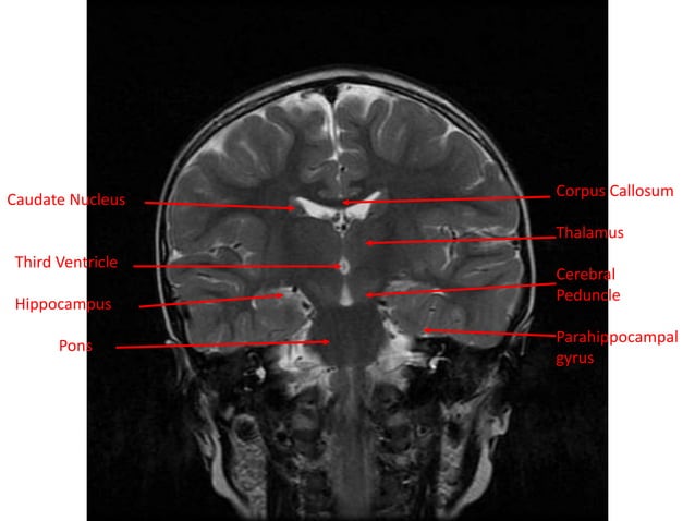 Normal mri brain | PPTX | Medical Tests | Medical Health