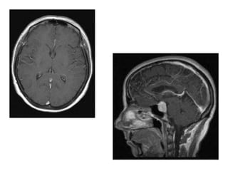 Normal mri brain | PPTX