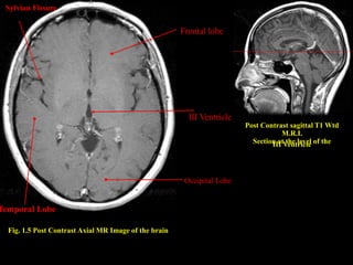 Mri Brain Normal