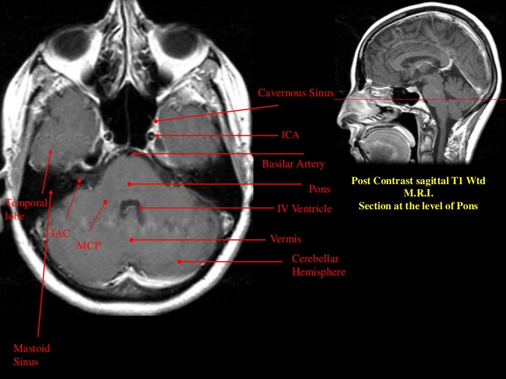 Normal mri brain