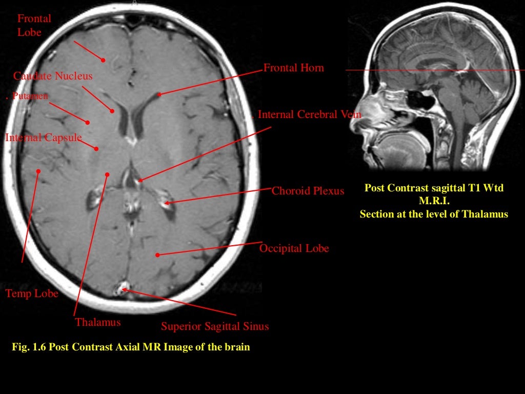 Normal mri brain