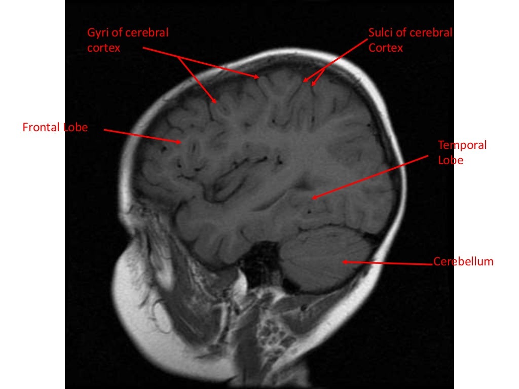 Normal mri brain