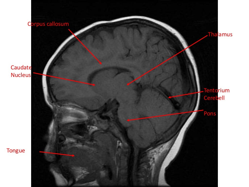 Normal mri brain