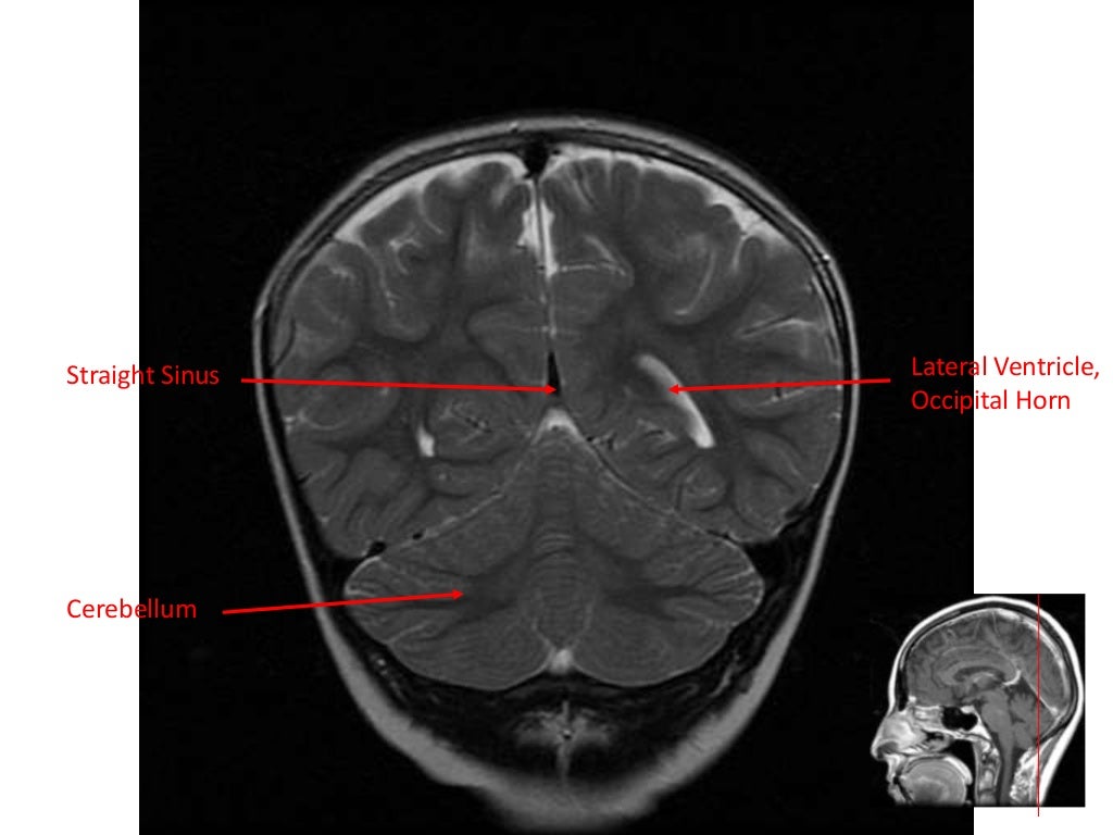 Normal mri brain