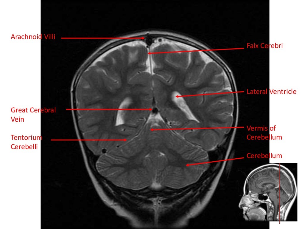 Normal mri brain