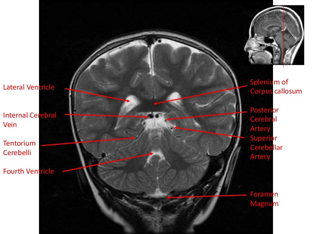 Normal mri brain