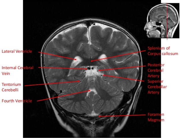 Normal mri brain