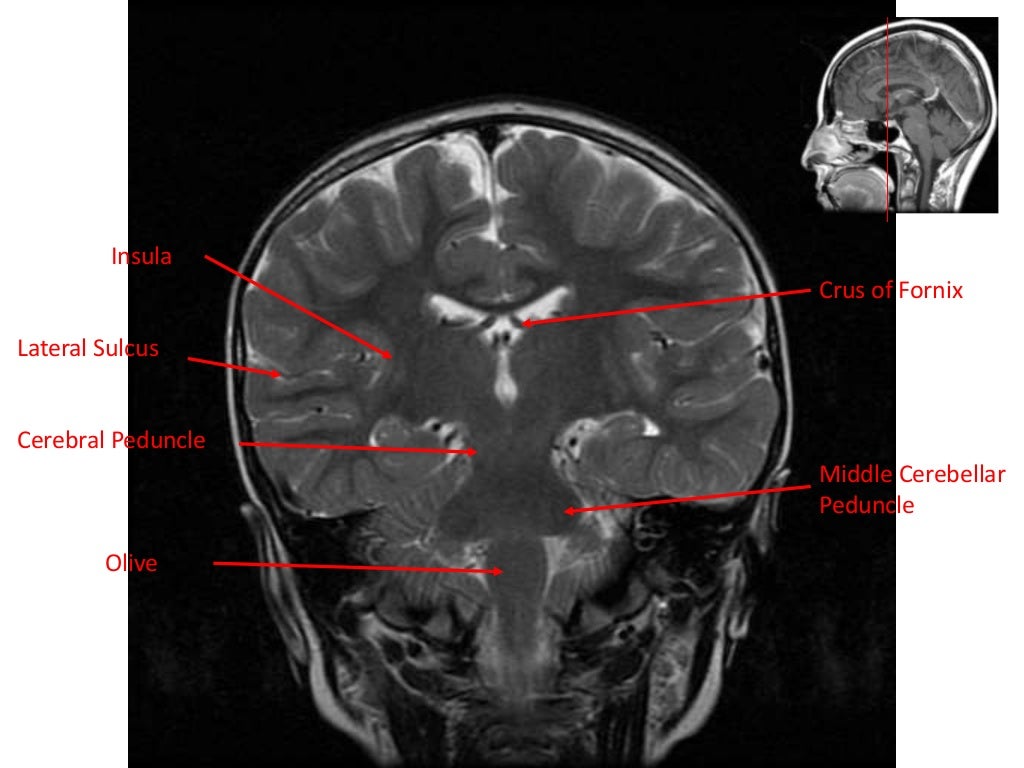Normal mri brain