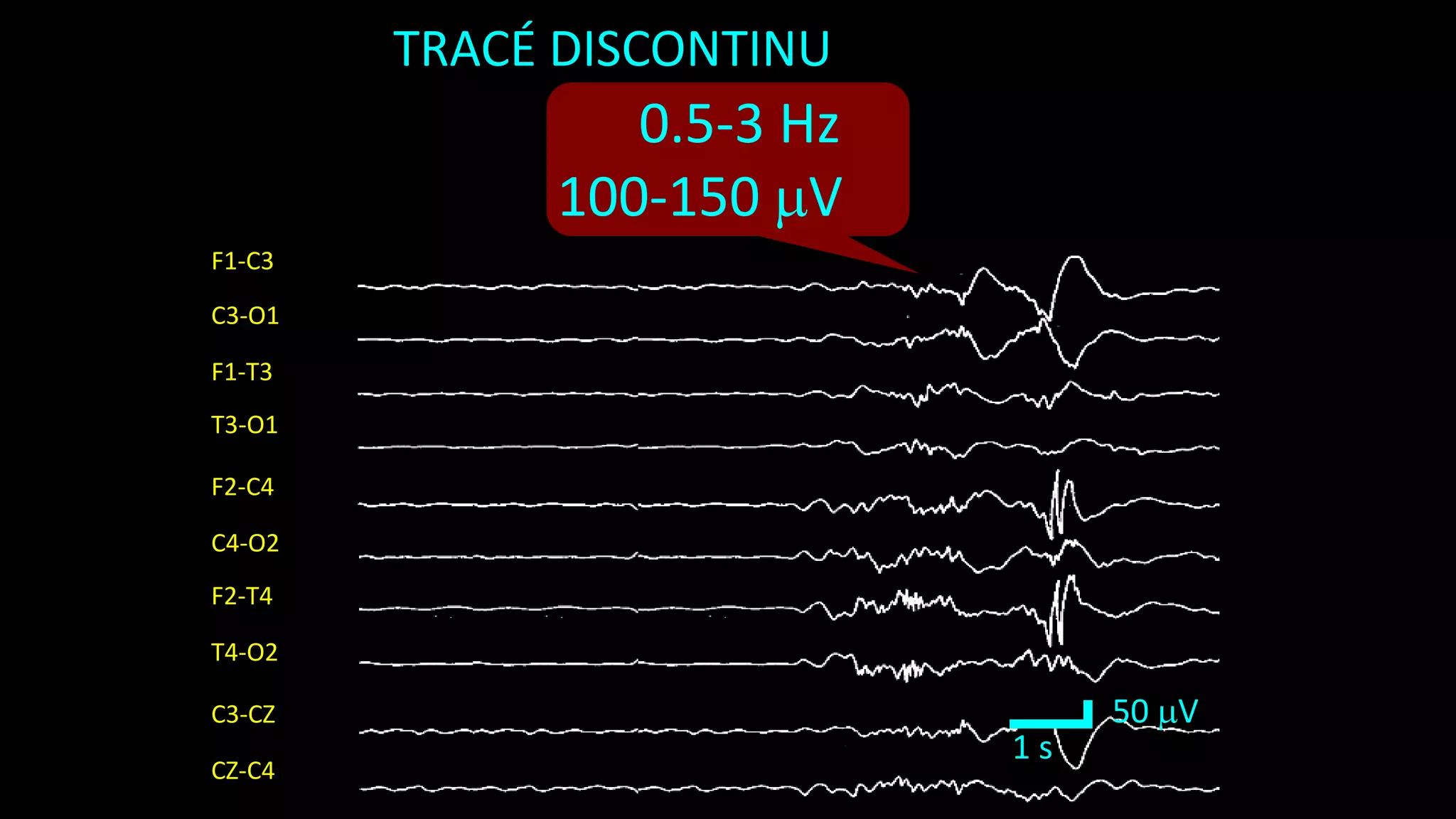Normal Neonatal EEG | PPTX