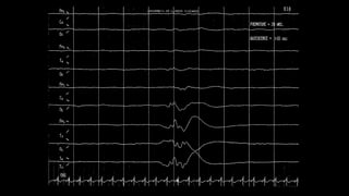 Normal Neonatal EEG | PPTX
