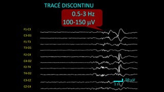 Normal Neonatal EEG | PPTX