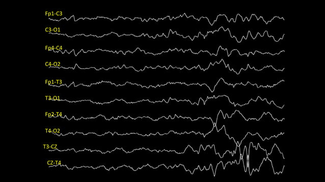 Normal Neonatal EEG | PPTX | Pregnancy | Reproductive Health