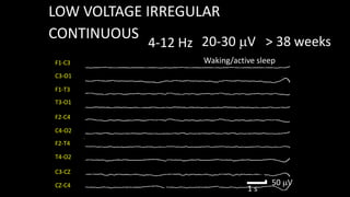 Normal Neonatal EEG | PPTX