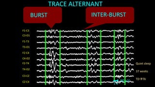 Normal Neonatal EEG | PPTX