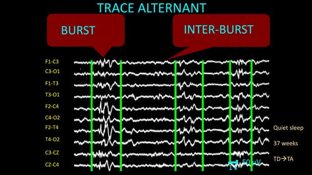 Normal Neonatal EEG | PPTX | Pregnancy | Reproductive Health