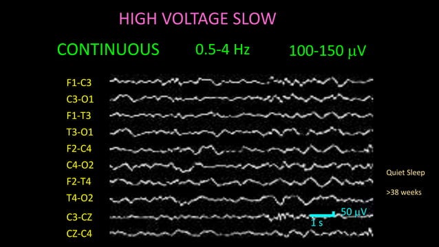 Normal Neonatal EEG | PPTX | Pregnancy | Reproductive Health