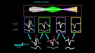 Normal Neonatal EEG | PPTX