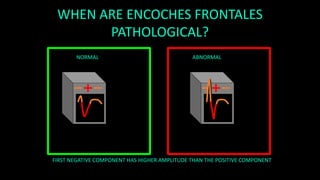 Normal Neonatal EEG | PPTX