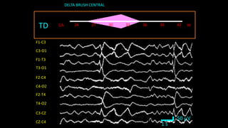 Normal Neonatal EEG | PPTX