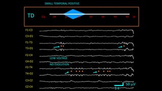 Normal Neonatal EEG | PPTX
