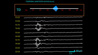 Normal Neonatal EEG | PPTX