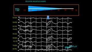 Normal Neonatal EEG | PPTX