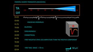 Normal Neonatal EEG | PPT