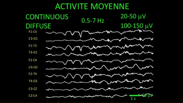 Normal Neonatal EEG
