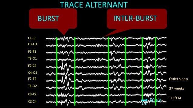 Normal Neonatal EEG
