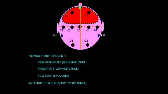 Normal Neonatal EEG