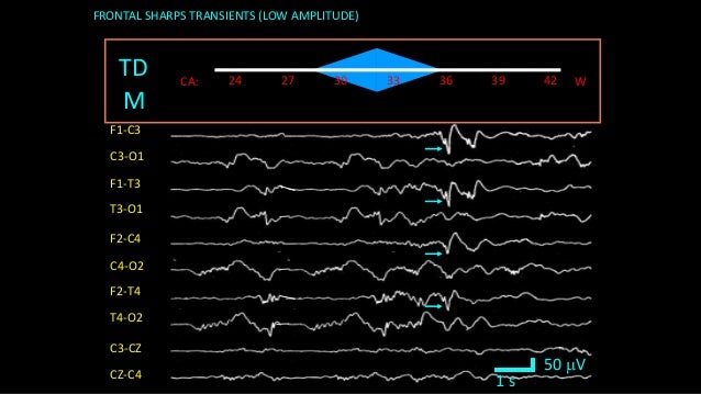 Normal Neonatal EEG