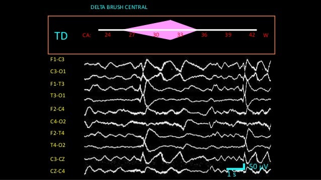 Normal Neonatal EEG