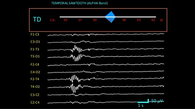 Normal Neonatal EEG